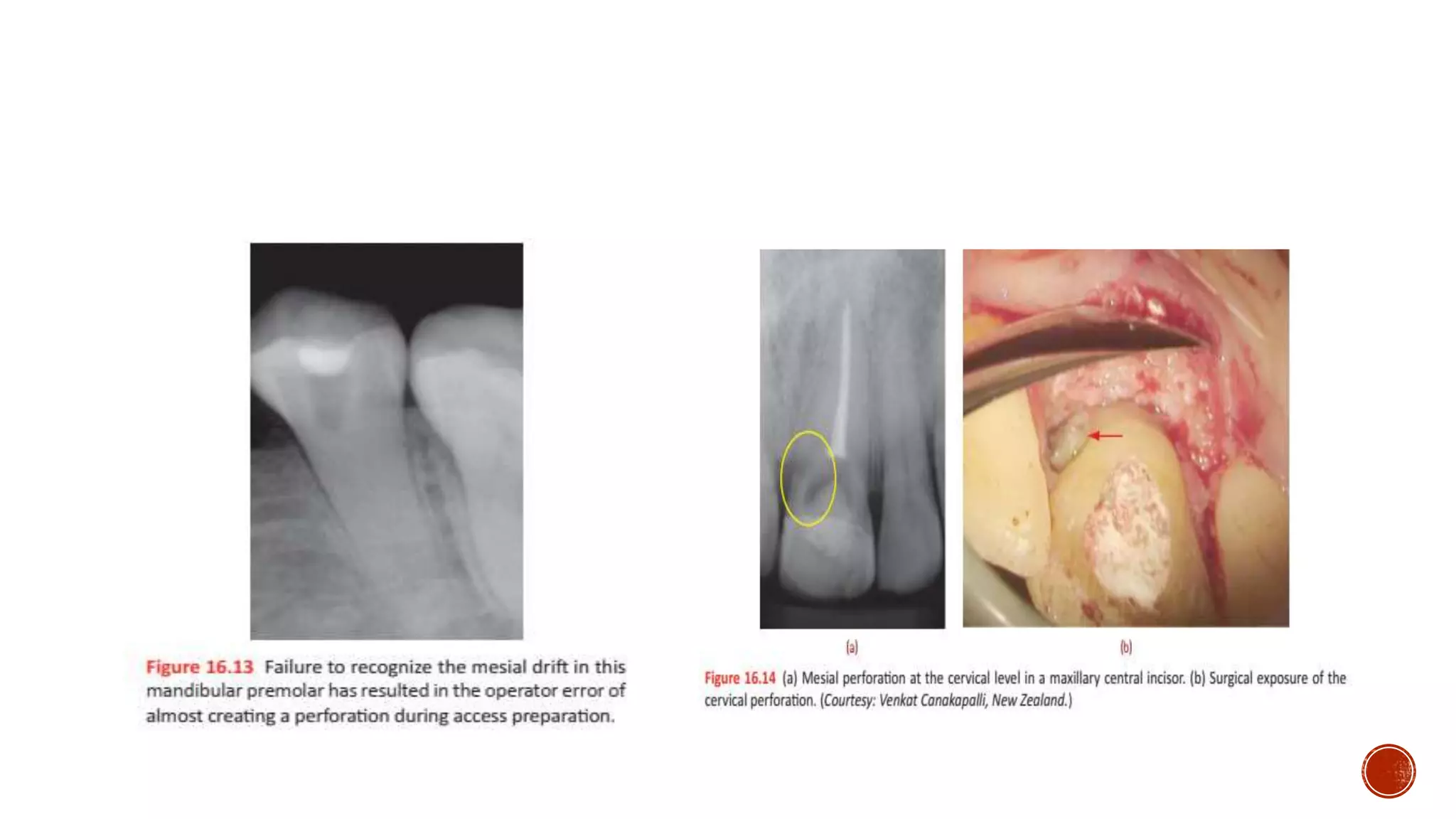 Procedural errors in endodontics | PPTX