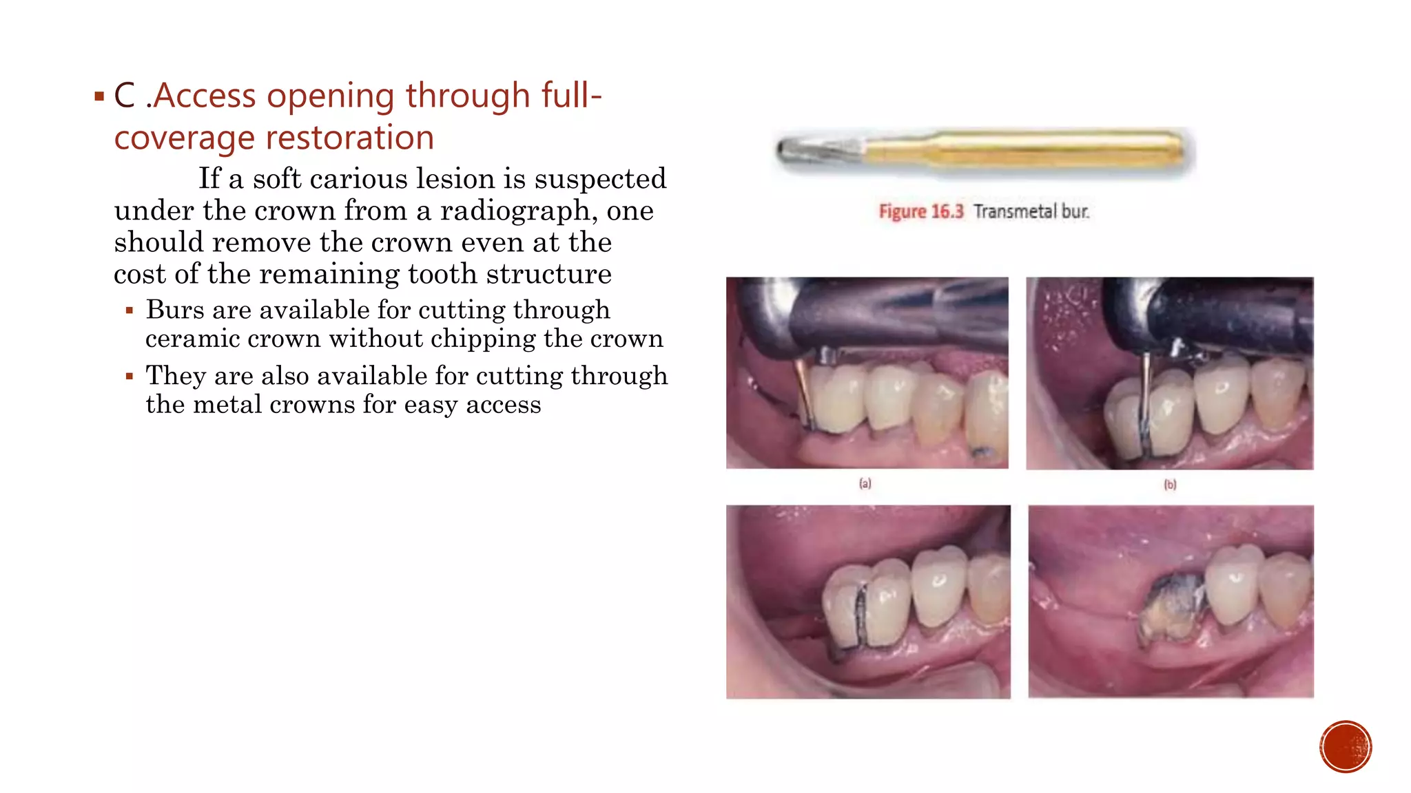 Procedural errors in endodontics | PPTX