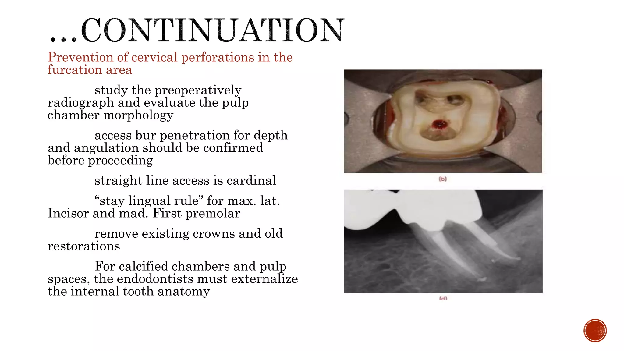 Procedural errors in endodontics | PPTX