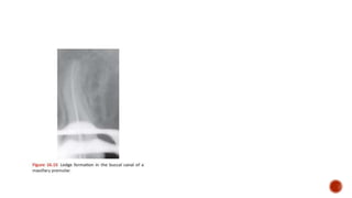 Procedural errors in endodontics | PPTX