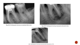 Procedural errors in endodontics | PPTX