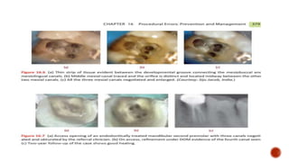 Procedural errors in endodontics | PPTX