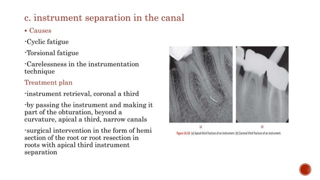 Procedural errors in endodontics