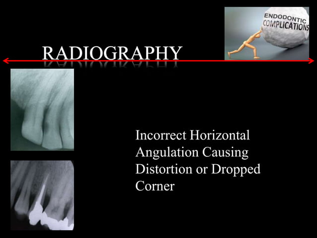 procedural errors in endodontics ppt.ppt | Dental Health | Diseases and ...
