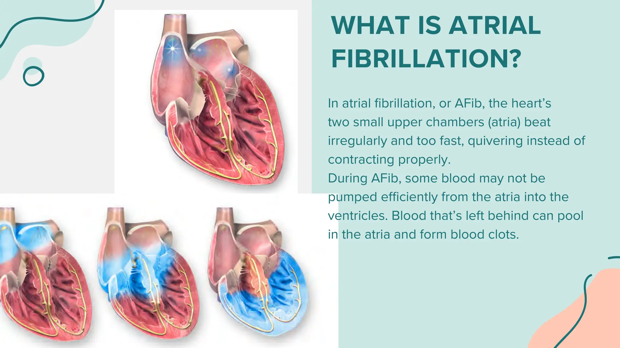 BASIC ECG RTHYM - STEMI- SVT -A FIB- SINUS BRADYCARDIA -TACHYCARDIA | PPT
