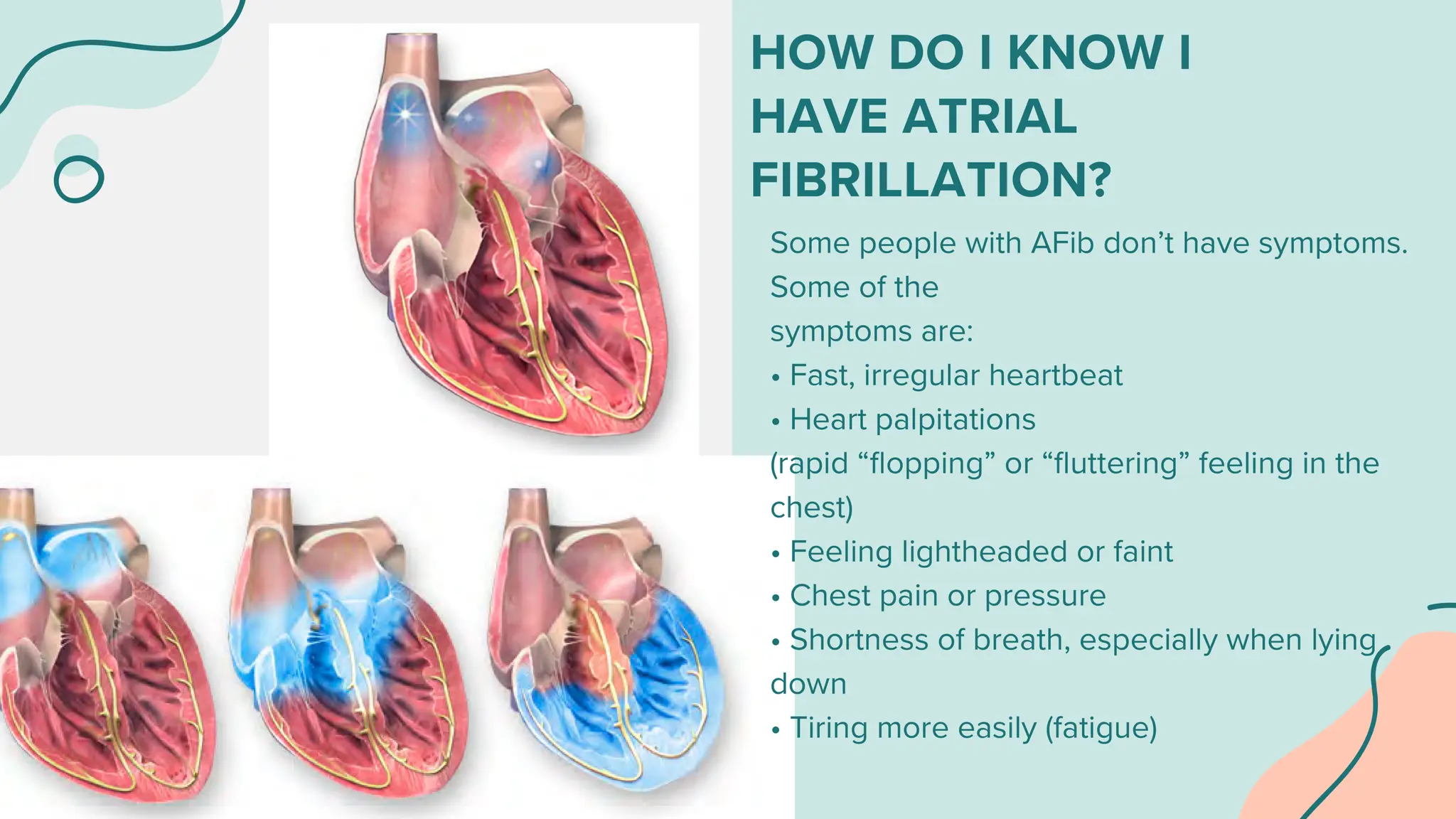 BASIC ECG RTHYM - STEMI- SVT -A FIB- SINUS BRADYCARDIA -TACHYCARDIA | PPT