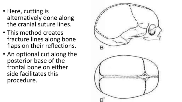 PROCEDURE FOR PEDIATRIC SKULL DISSECTION IN AN AUTOPSY.pptx