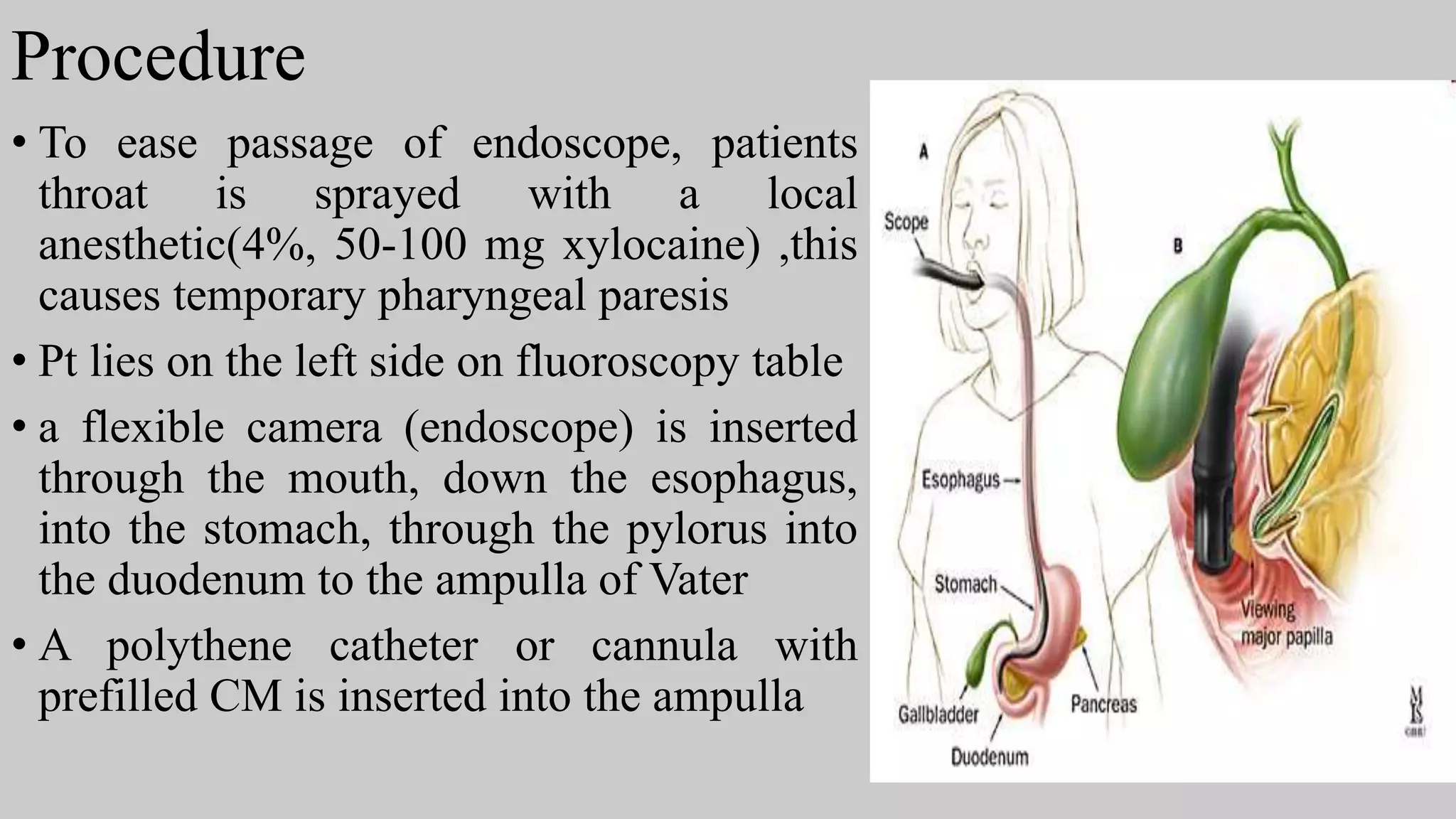 Procedure of ercp and t tube cholangiography | PPTX