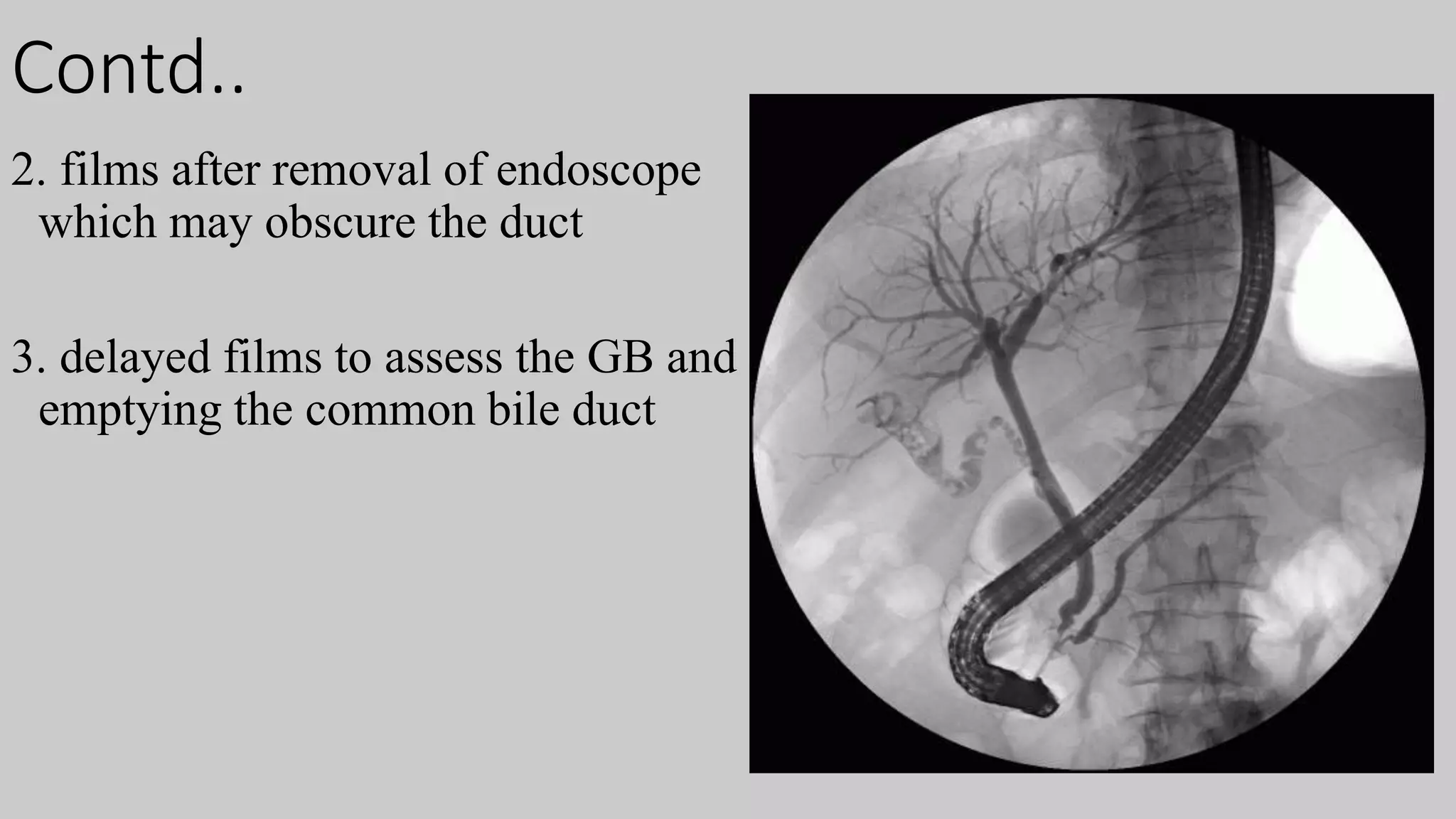 Procedure of ercp and t tube cholangiography | PPTX