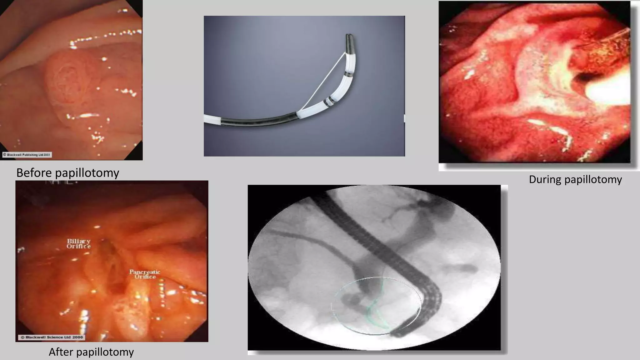 Procedure of ercp and t tube cholangiography | PPTX