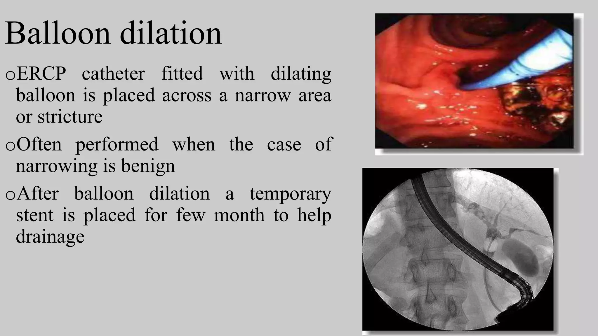 Procedure of ercp and t tube cholangiography | PPTX