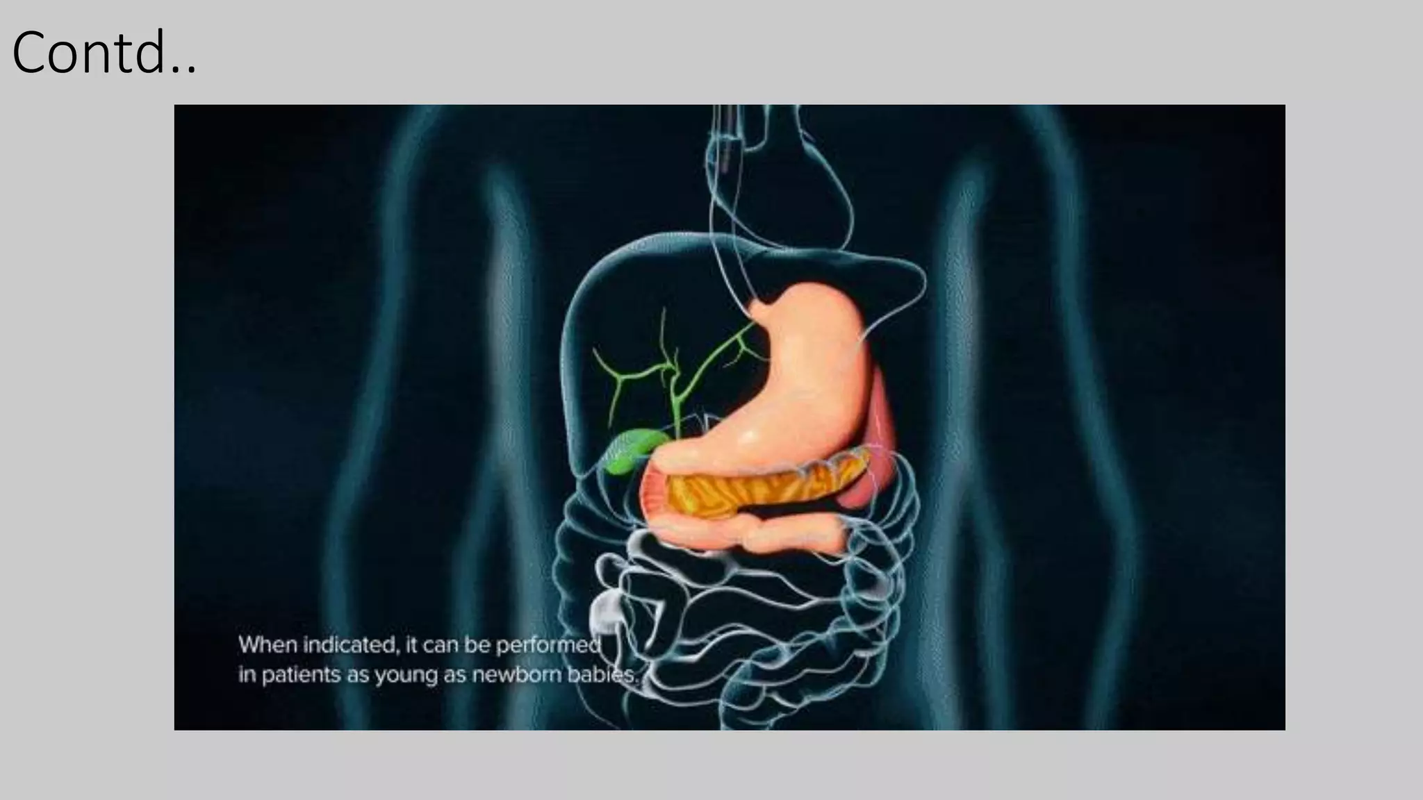 Procedure of ercp and t tube cholangiography | PPTX