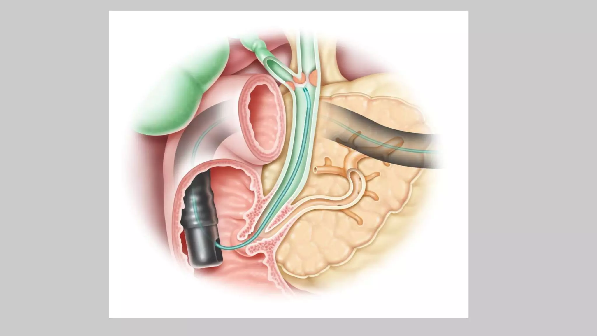Procedure of ercp and t tube cholangiography | PPTX