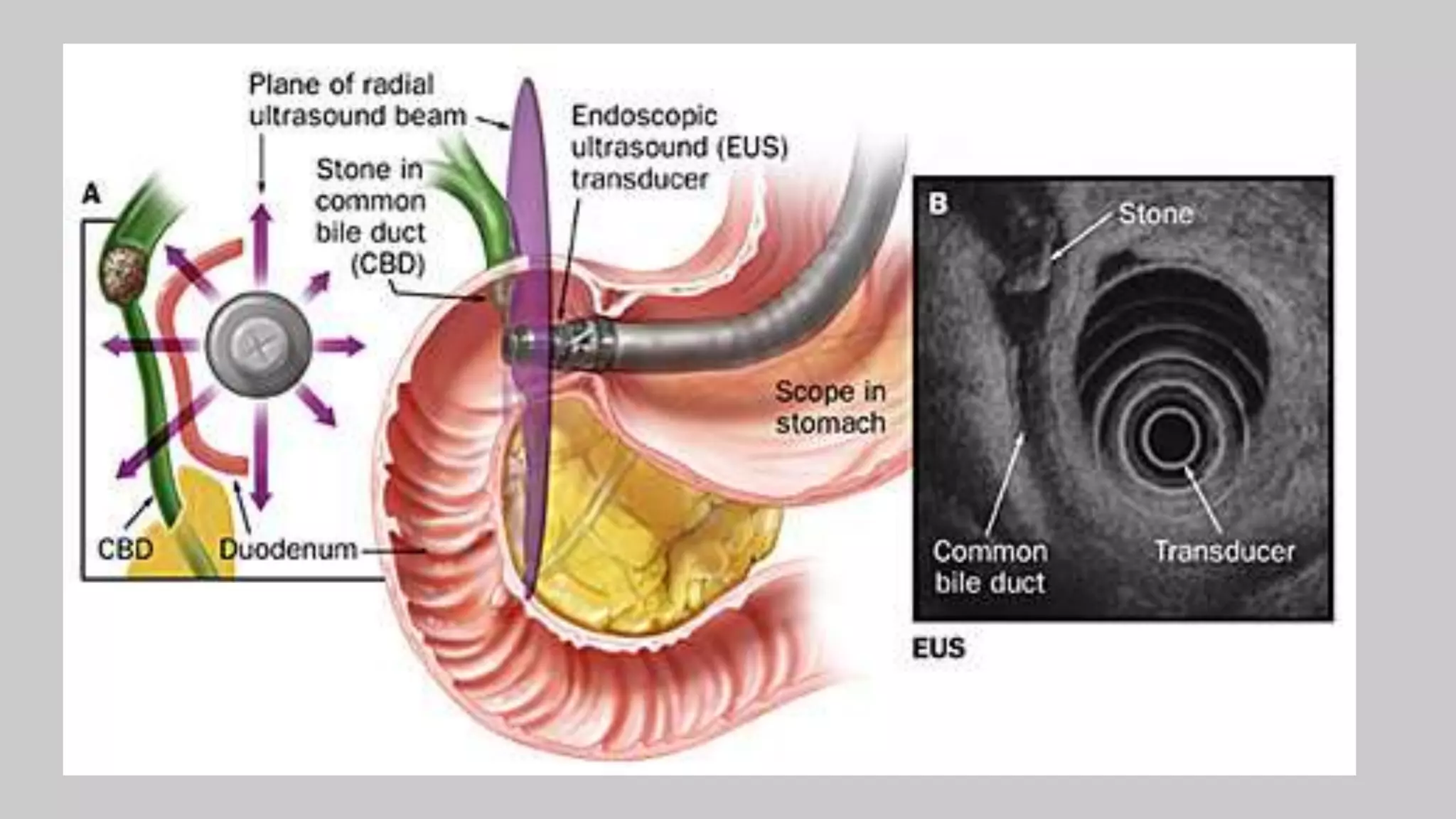 Procedure of ercp and t tube cholangiography | PPTX