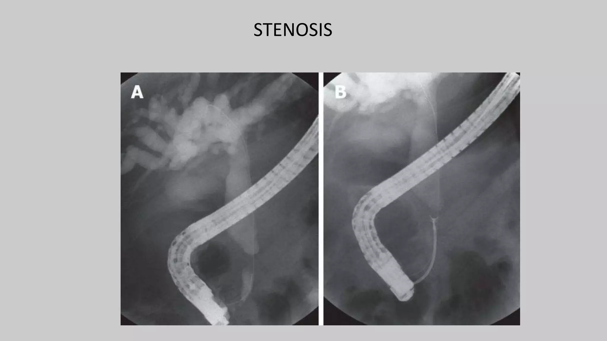 Procedure of ercp and t tube cholangiography | PPTX