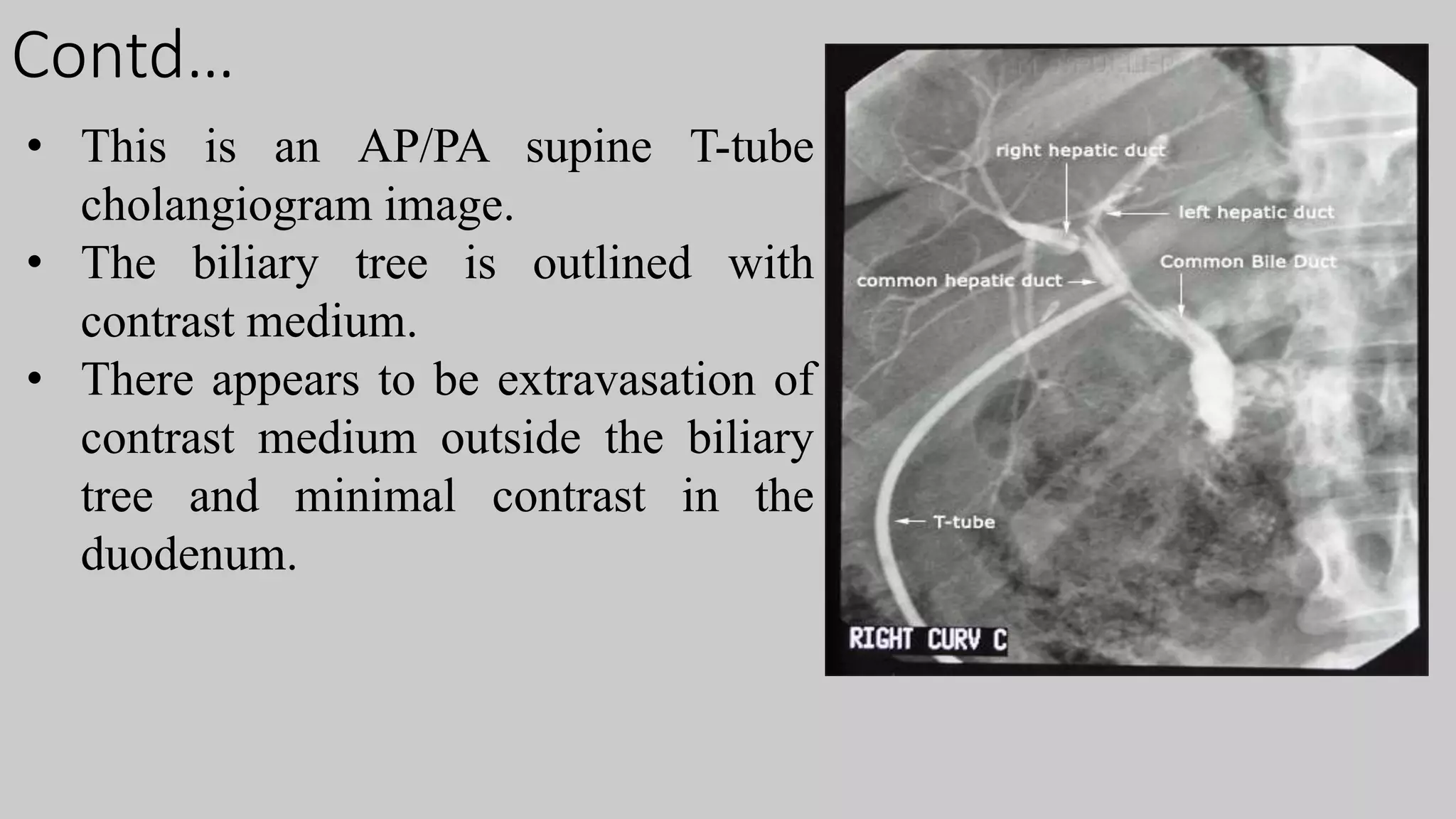 Procedure of ercp and t tube cholangiography | PPTX