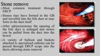 Procedure of ercp and t tube cholangiography | PPTX