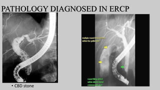 Procedure of ercp and t tube cholangiography | PPTX