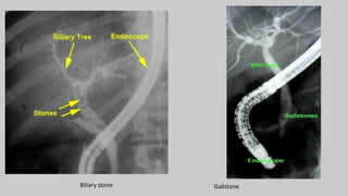Procedure of ercp and t tube cholangiography | PPTX