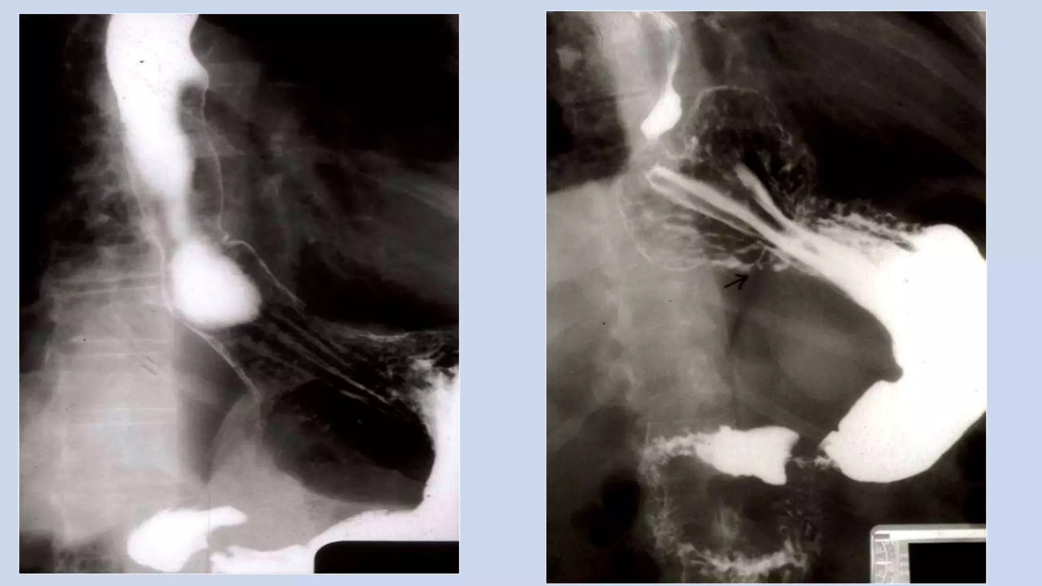 Procedure of upper gi | PPTX