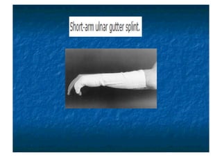 Procedures Presentation Volur splint | PDF | Surgery | Medical Health