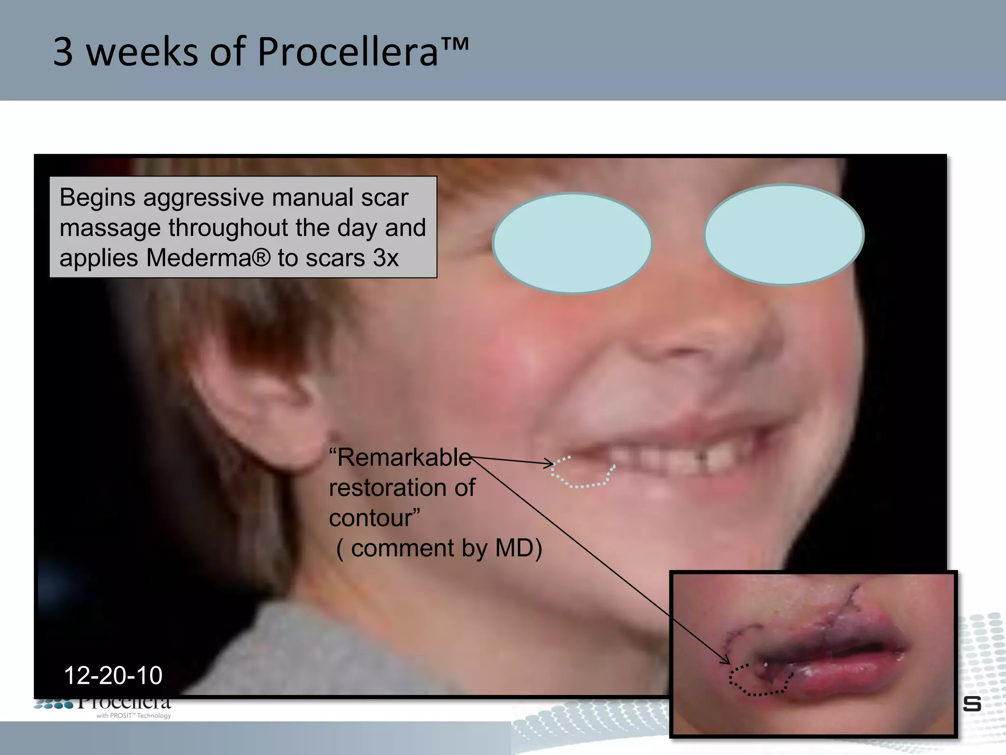 Procellera case study dogbite | PDF