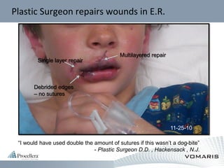 Procellera case study dogbite | PPT