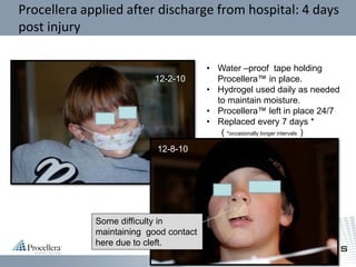 Procellera case study dogbite | PPT