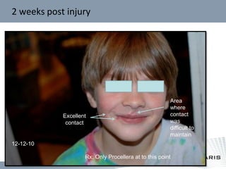 Procellera case study dogbite | PPT