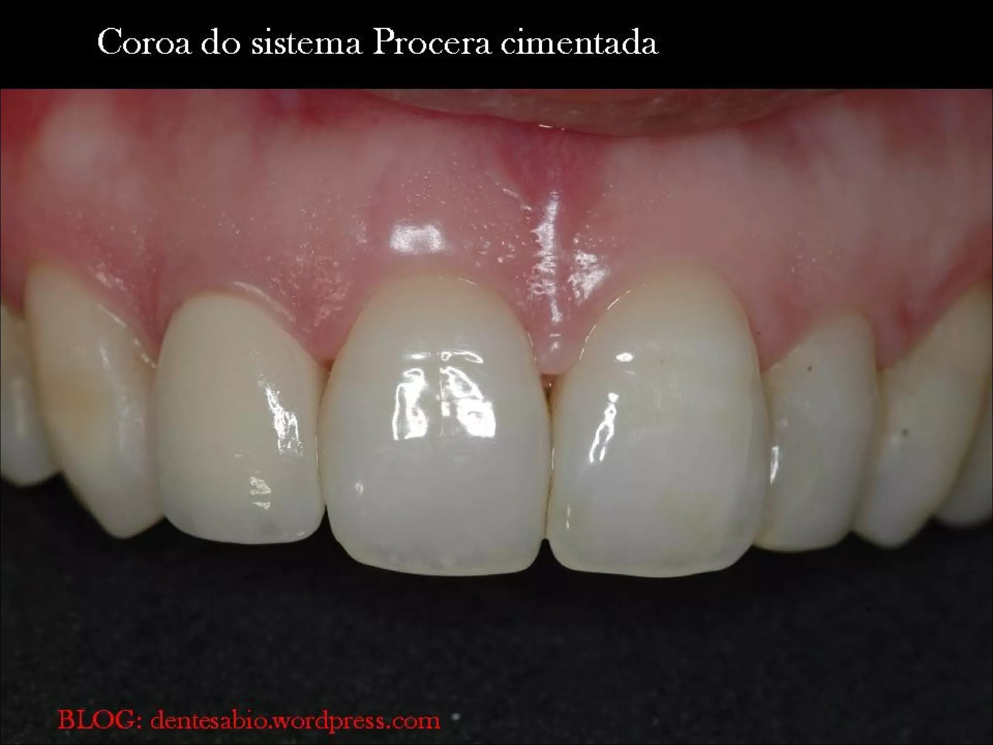 Procera coroa | PPT