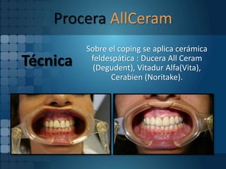 Coronas Procera All Ceram | PPTX