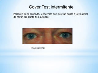 Proceso de realizacion del cover test | PPTX