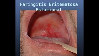 faringitis y procesos inflamatorios en general