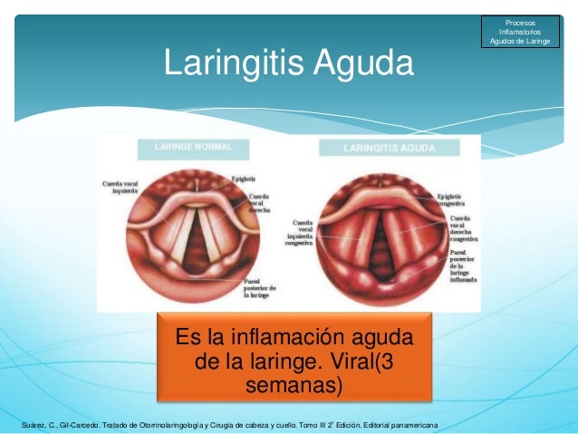 Laringitis Agudas
