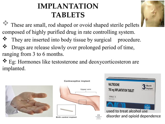Tablets: Introduction, ideal characteristics of tablets, classification ...