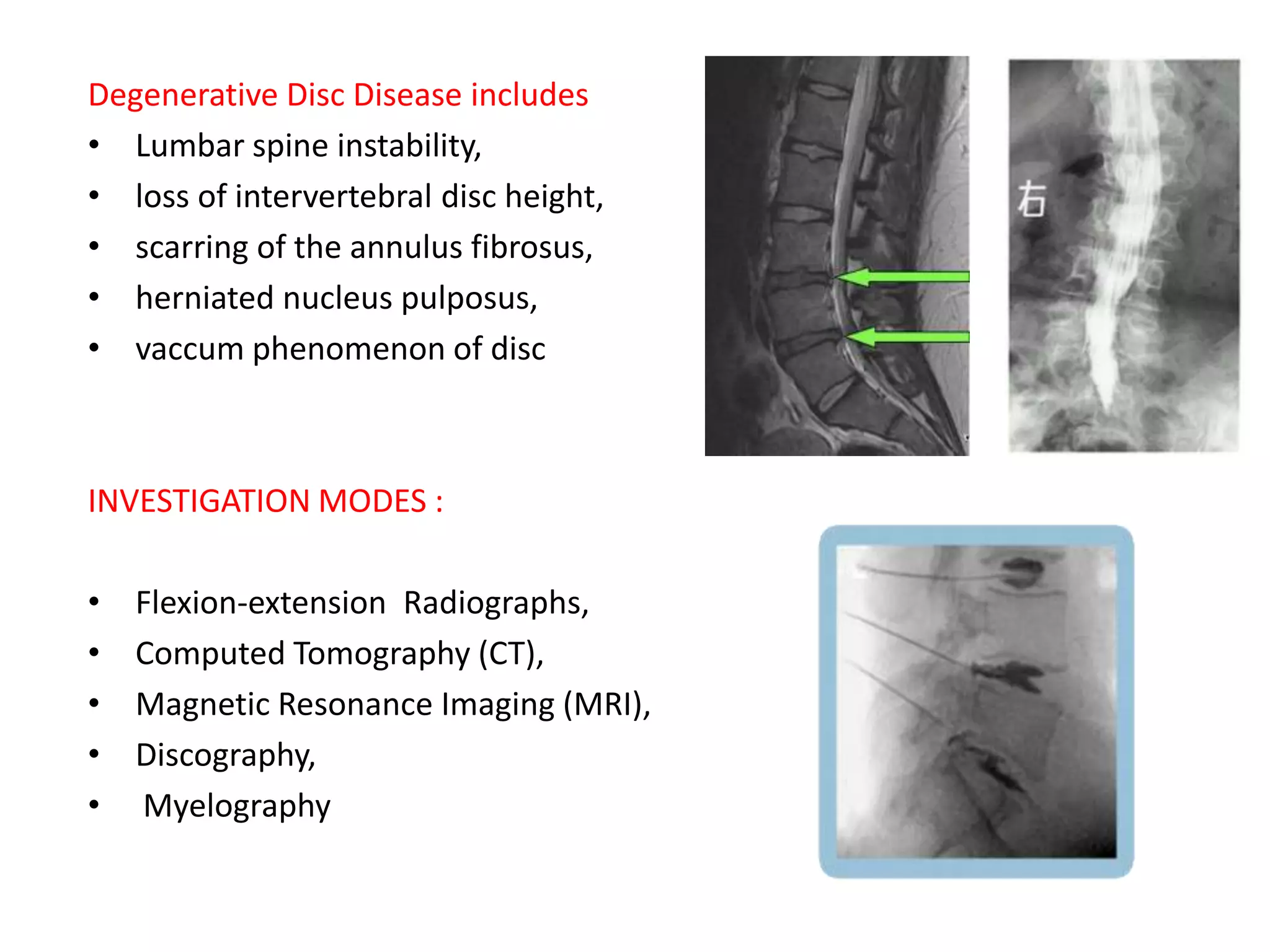 Pro disc l replacement vs circumferential arthrodesis of spine | PPT