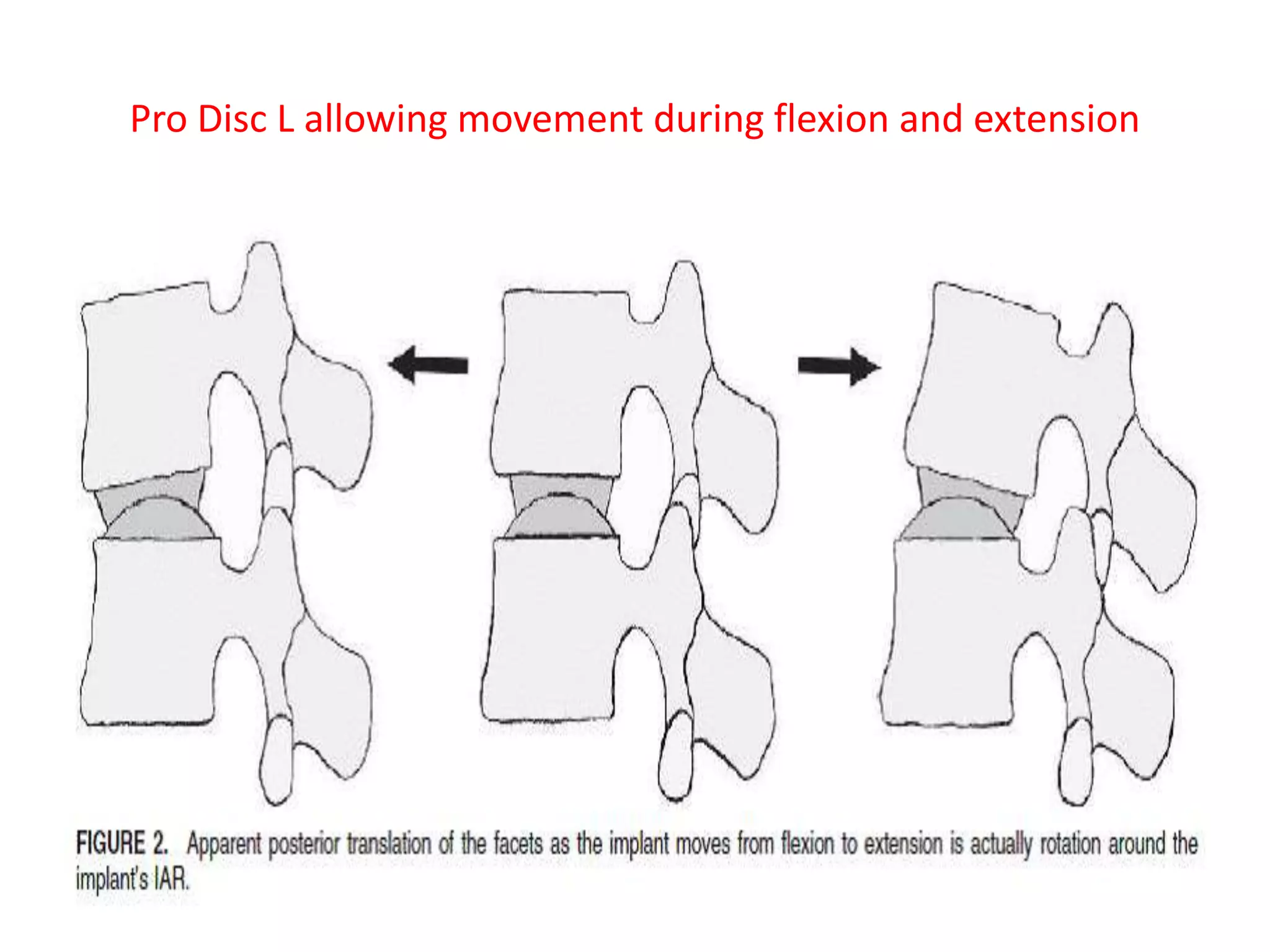 Pro disc l replacement vs circumferential arthrodesis of spine | PPT