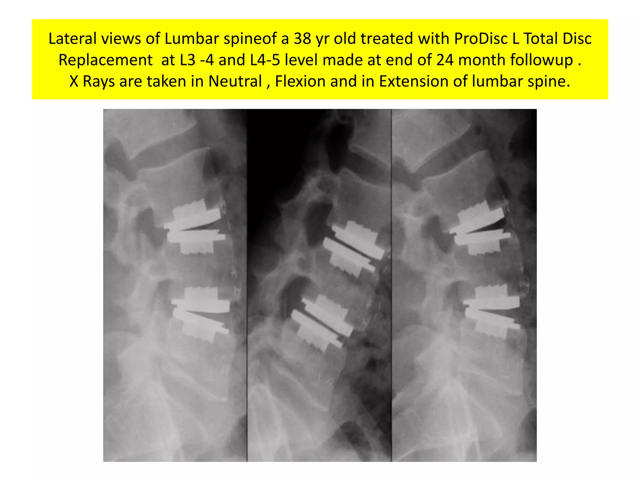 Pro disc l replacement vs circumferential arthrodesis of spine | PPT