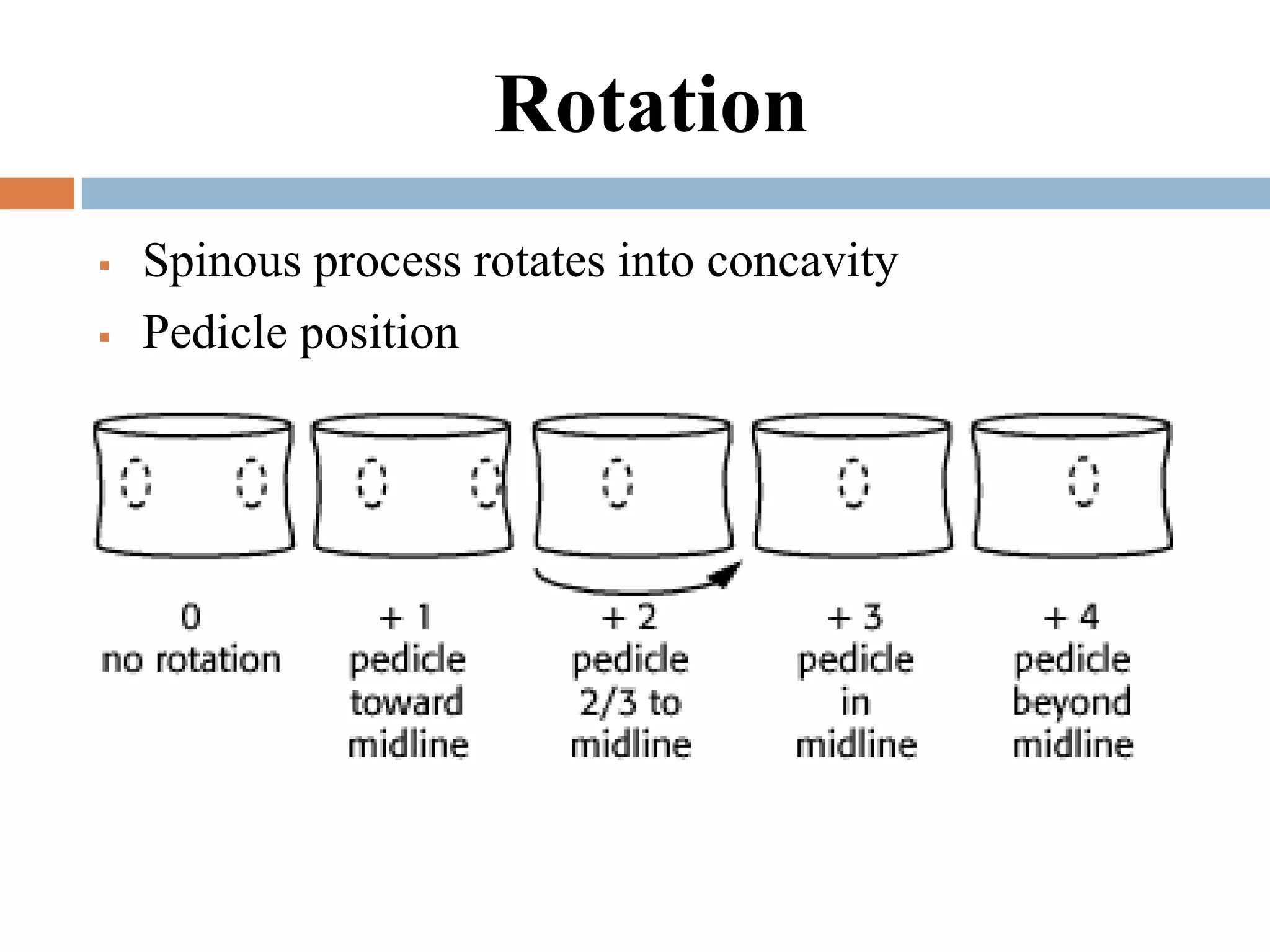 Prof. shah alam scoliosis 11 | PPTX