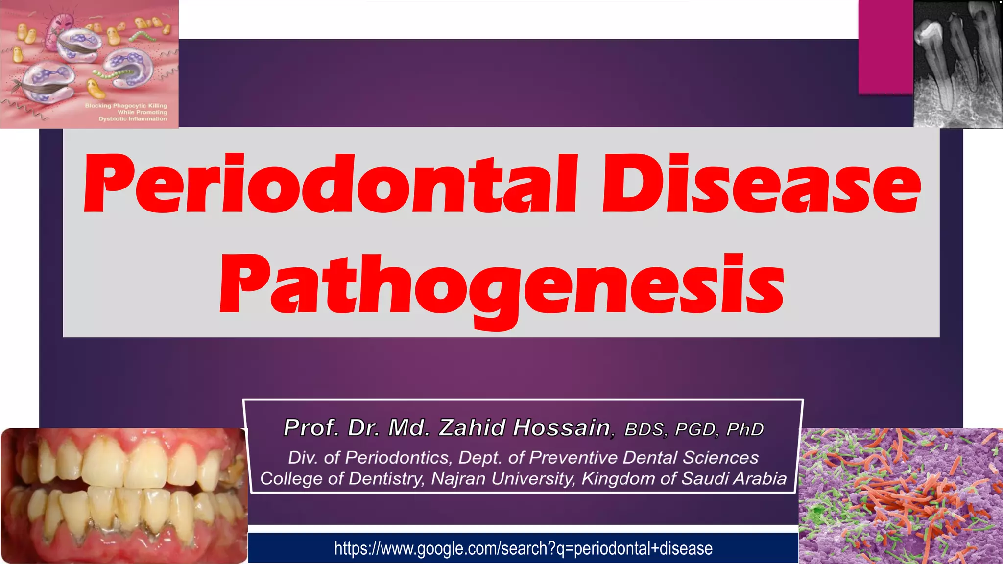 periodonta Disease pathogenesis | PDF
