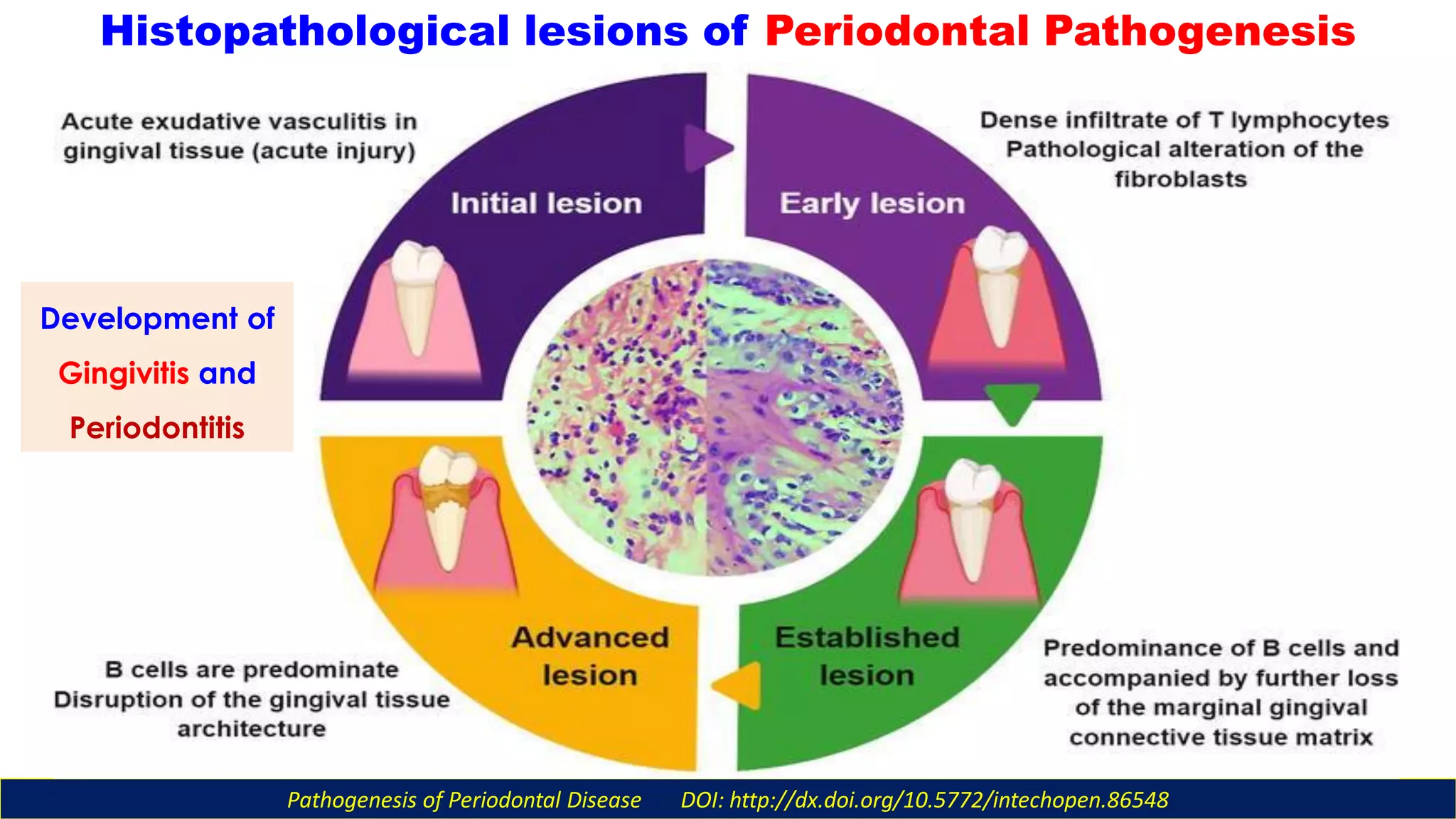periodonta Disease pathogenesis | PDF