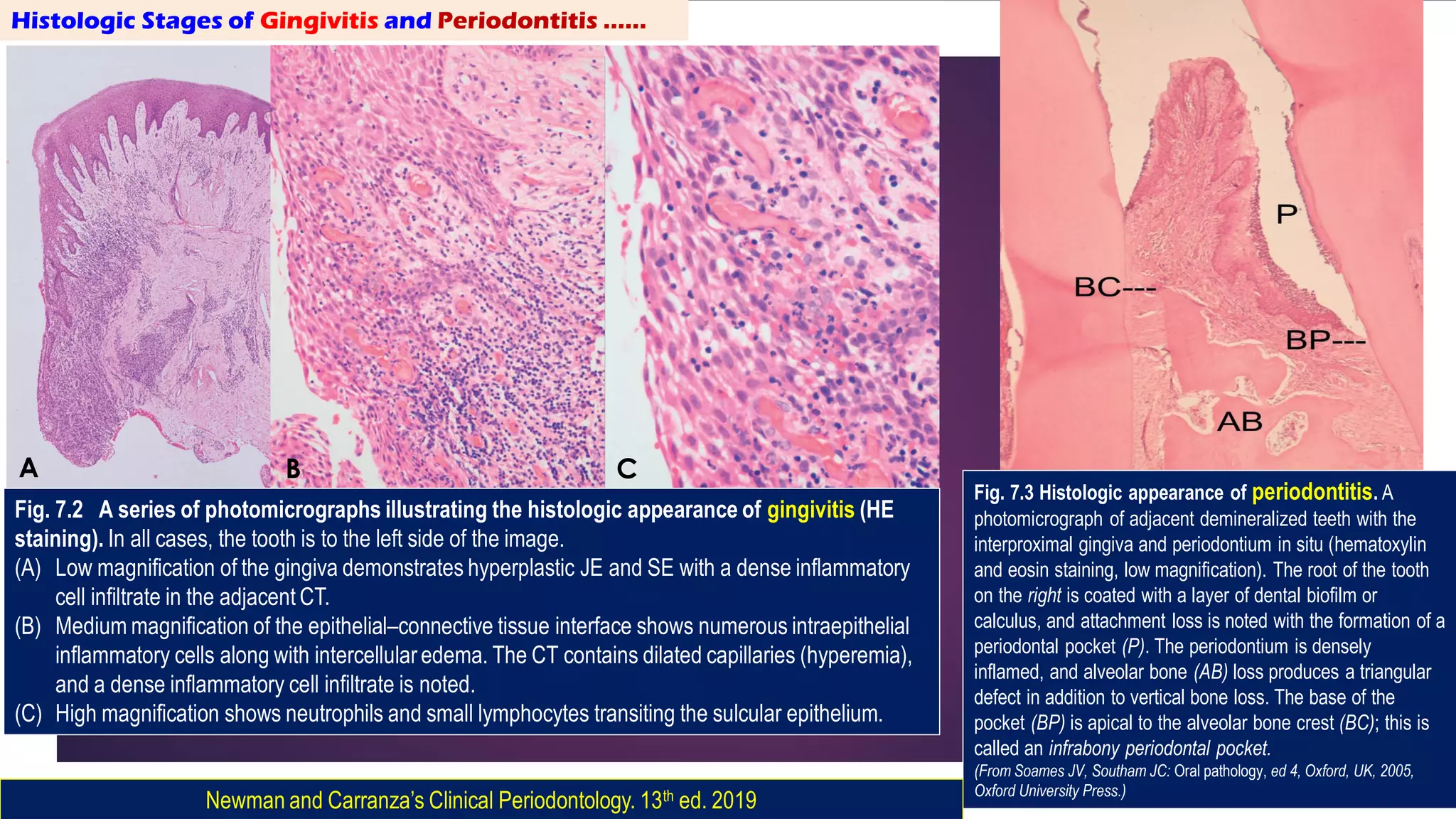 periodonta Disease pathogenesis | PDF