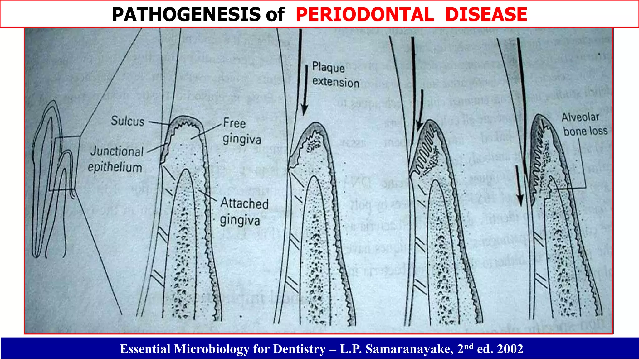 periodonta Disease pathogenesis | PDF