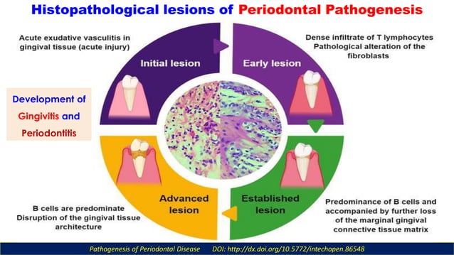 Periodonta Disease Pathogenesis Pdf Dental Health Diseases And