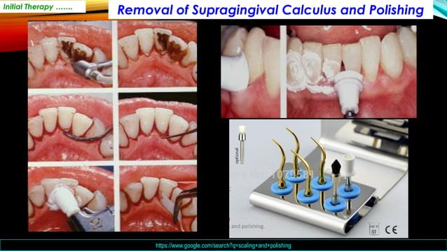 Periodontal Treatment Planning & Phase I Therapy | PDF