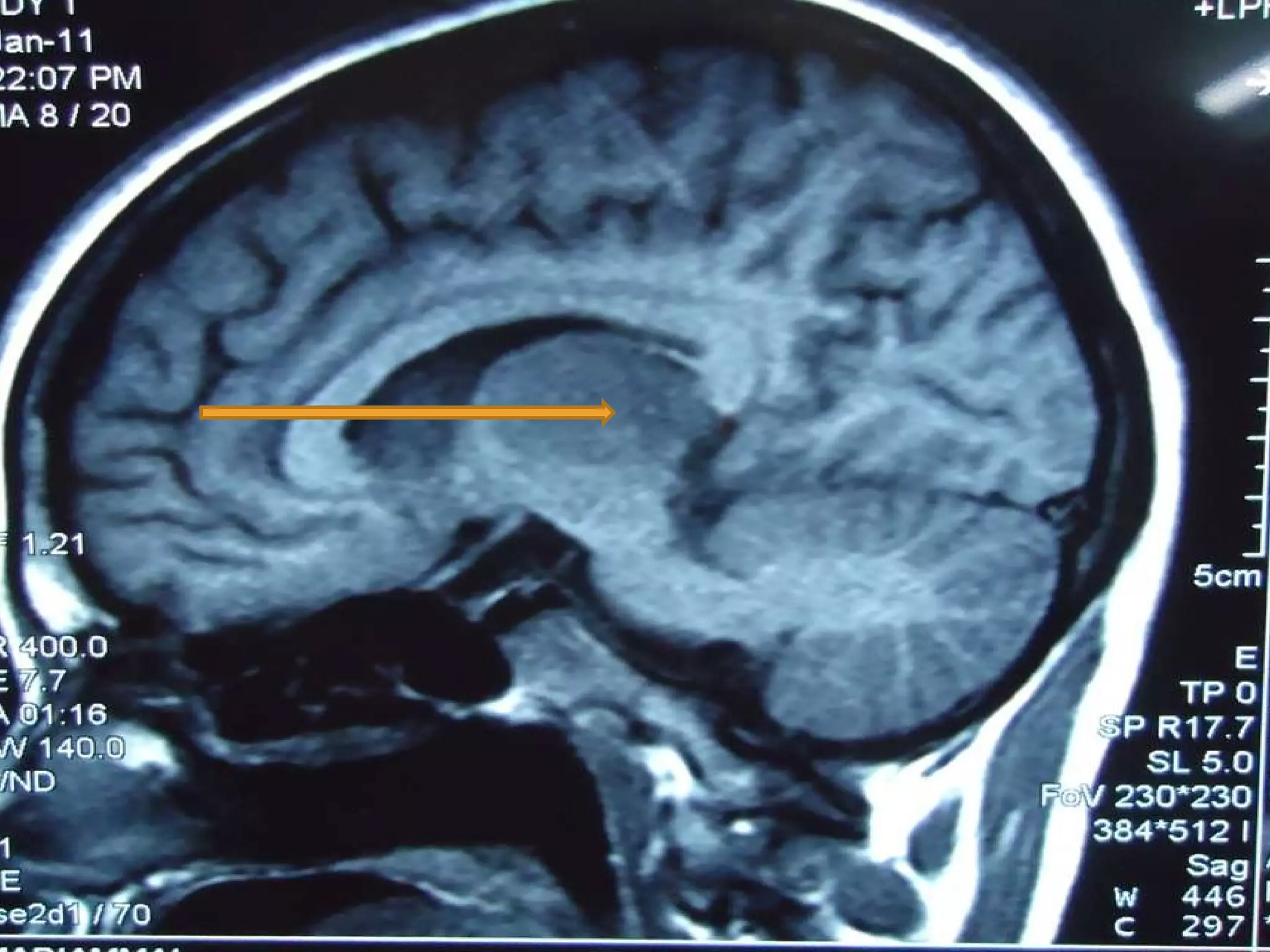 MRI: Bilateral Thalamic Hyperintensities | PPT