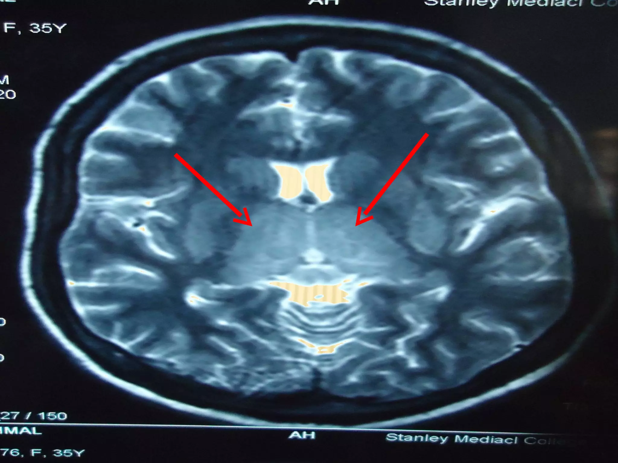 MRI: Bilateral Thalamic Hyperintensities | PPT