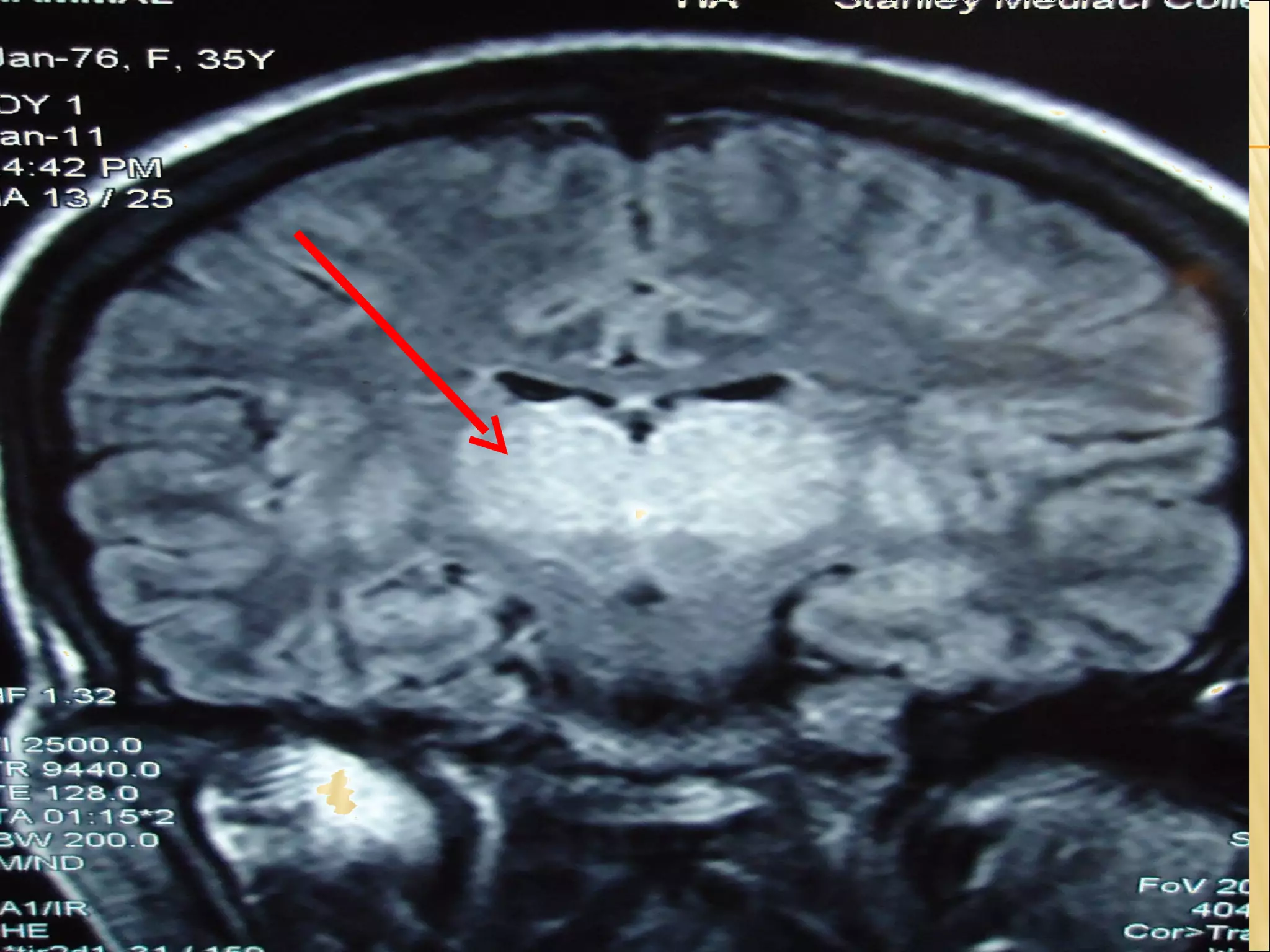 MRI: Bilateral Thalamic Hyperintensities | PPT