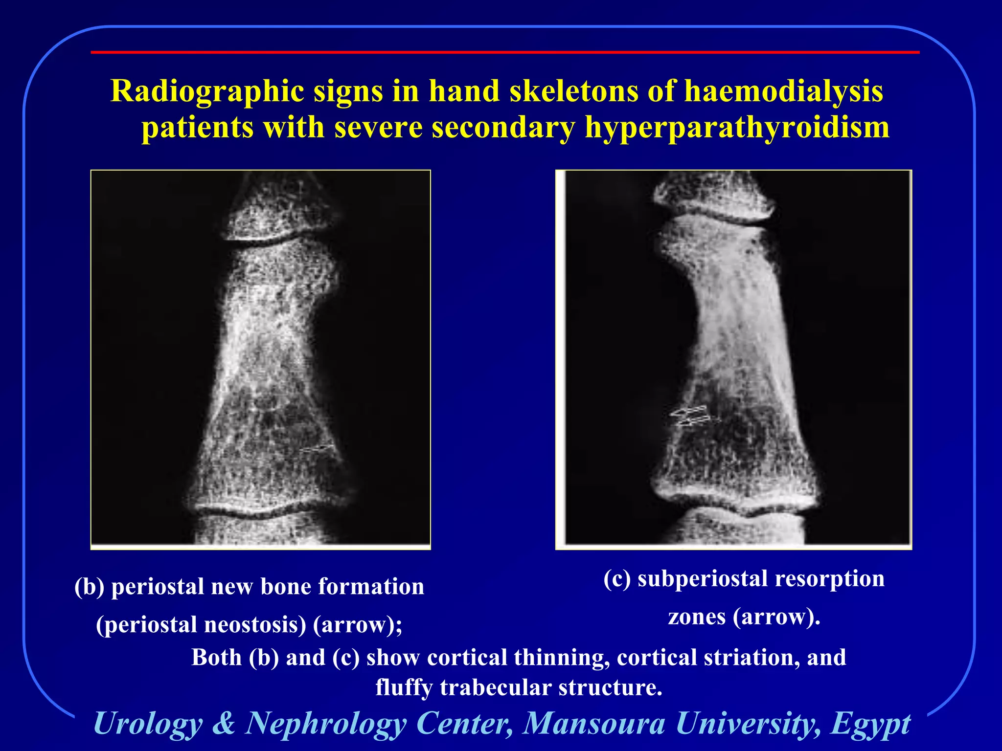 Prof sobh renal osteodystrophy | PPT | Endocrine and Metabolic Diseases ...