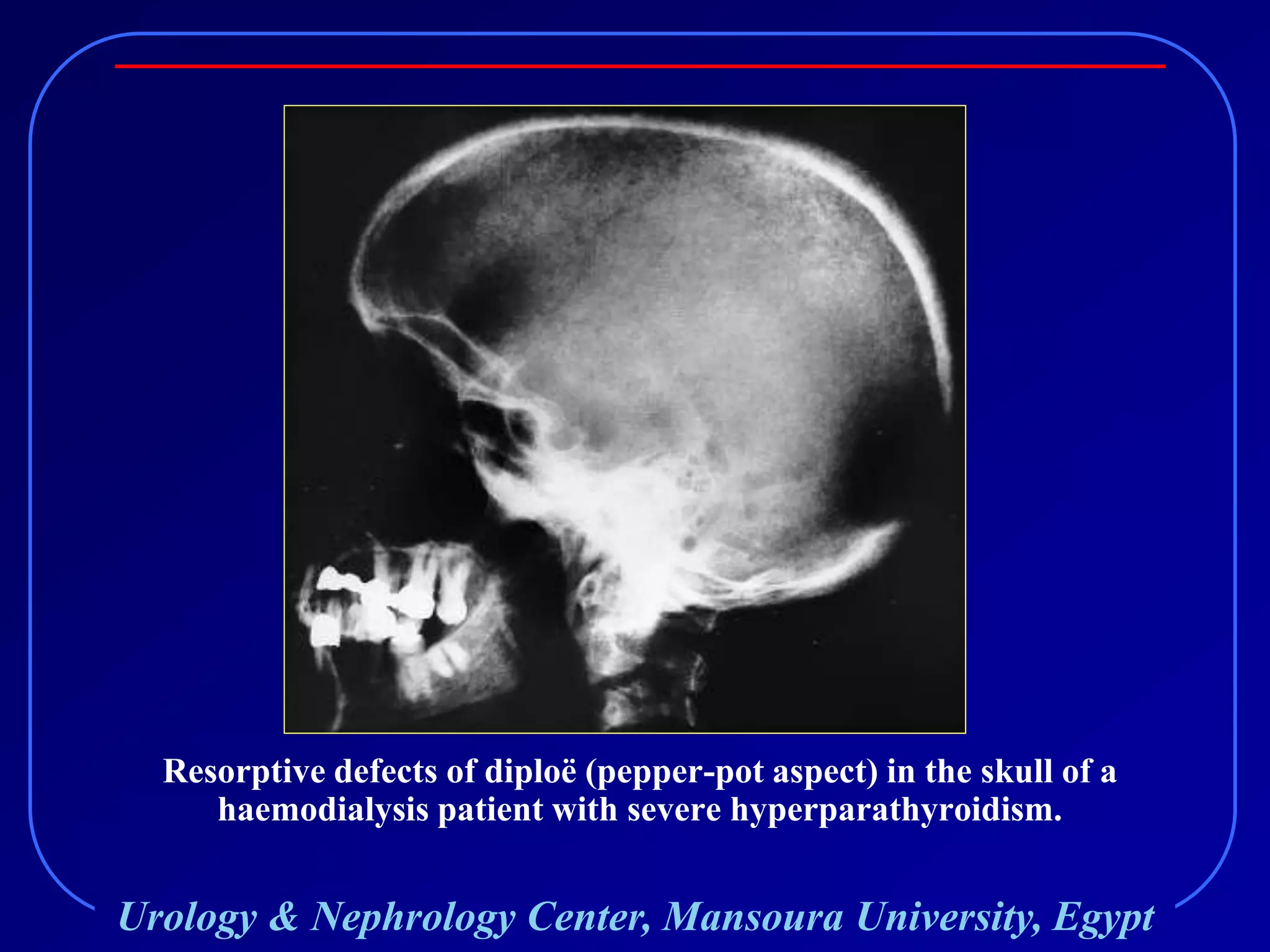 Prof sobh renal osteodystrophy | PPT
